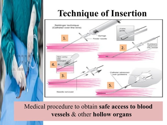 Central Venous Catheter Care- A Nursing skill | PDF