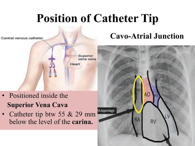 Central Venous Catheter Care- A Nursing skill | PDF