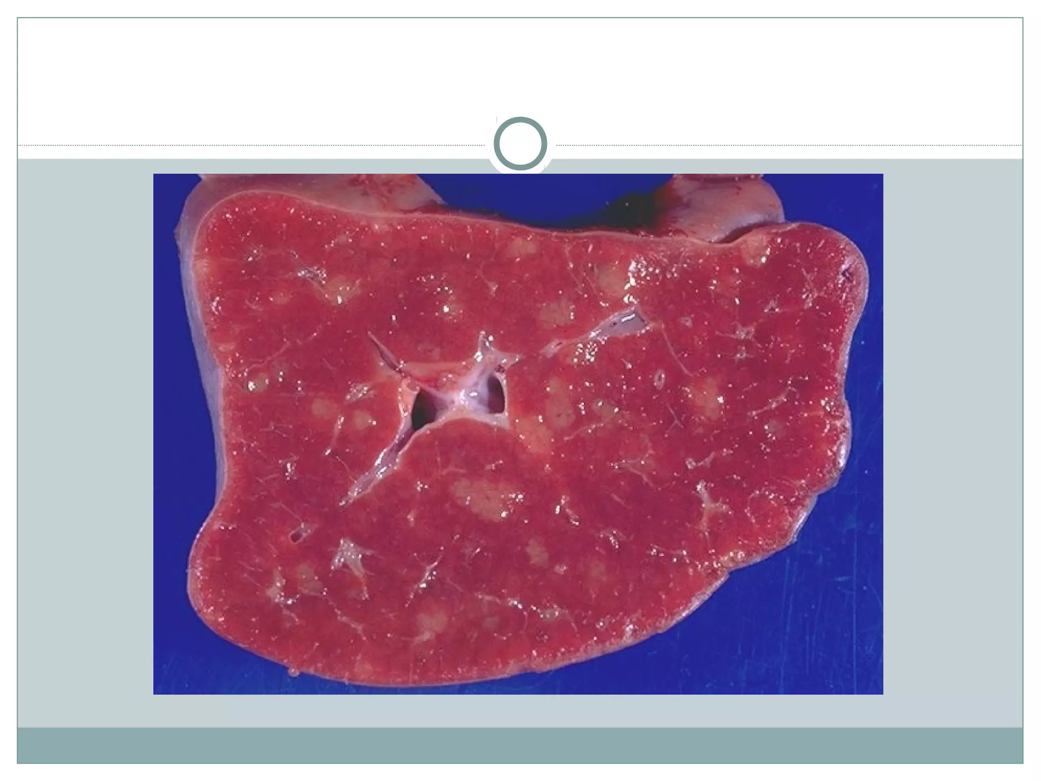 Cvc lung, liver and spleen | PPT