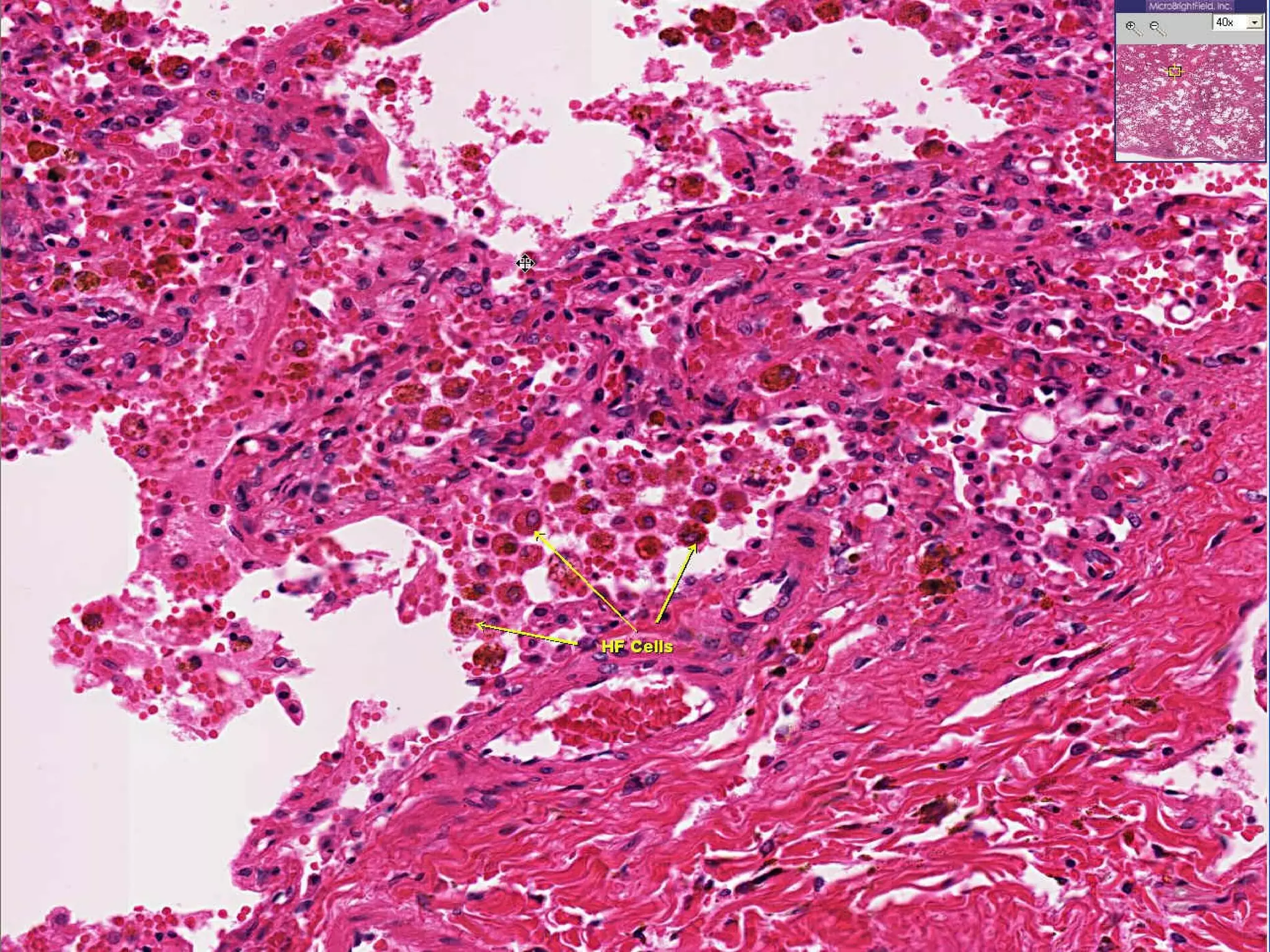 Cvc lung, liver and spleen | PPT