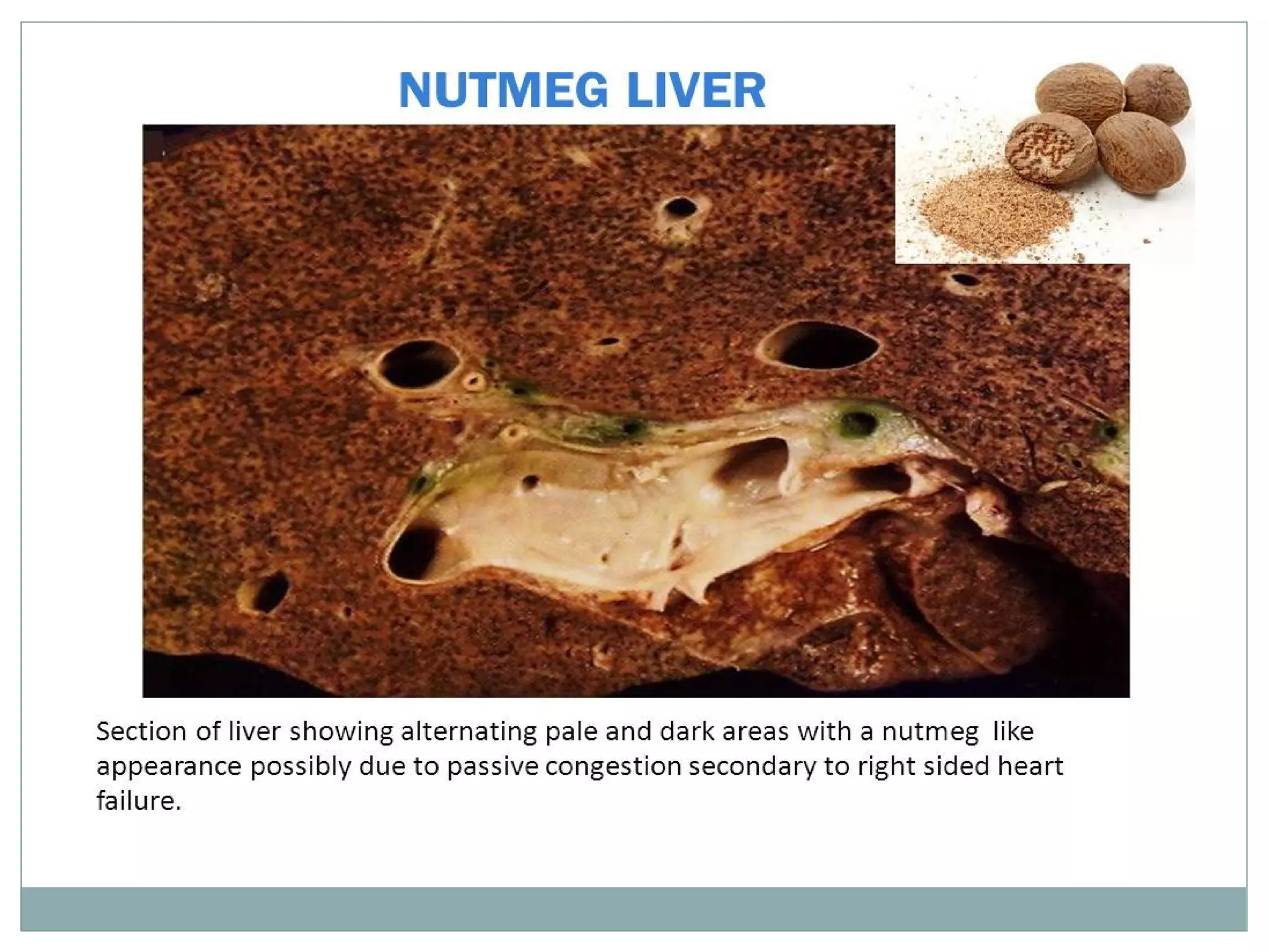 Cvc lung, liver and spleen | PPT
