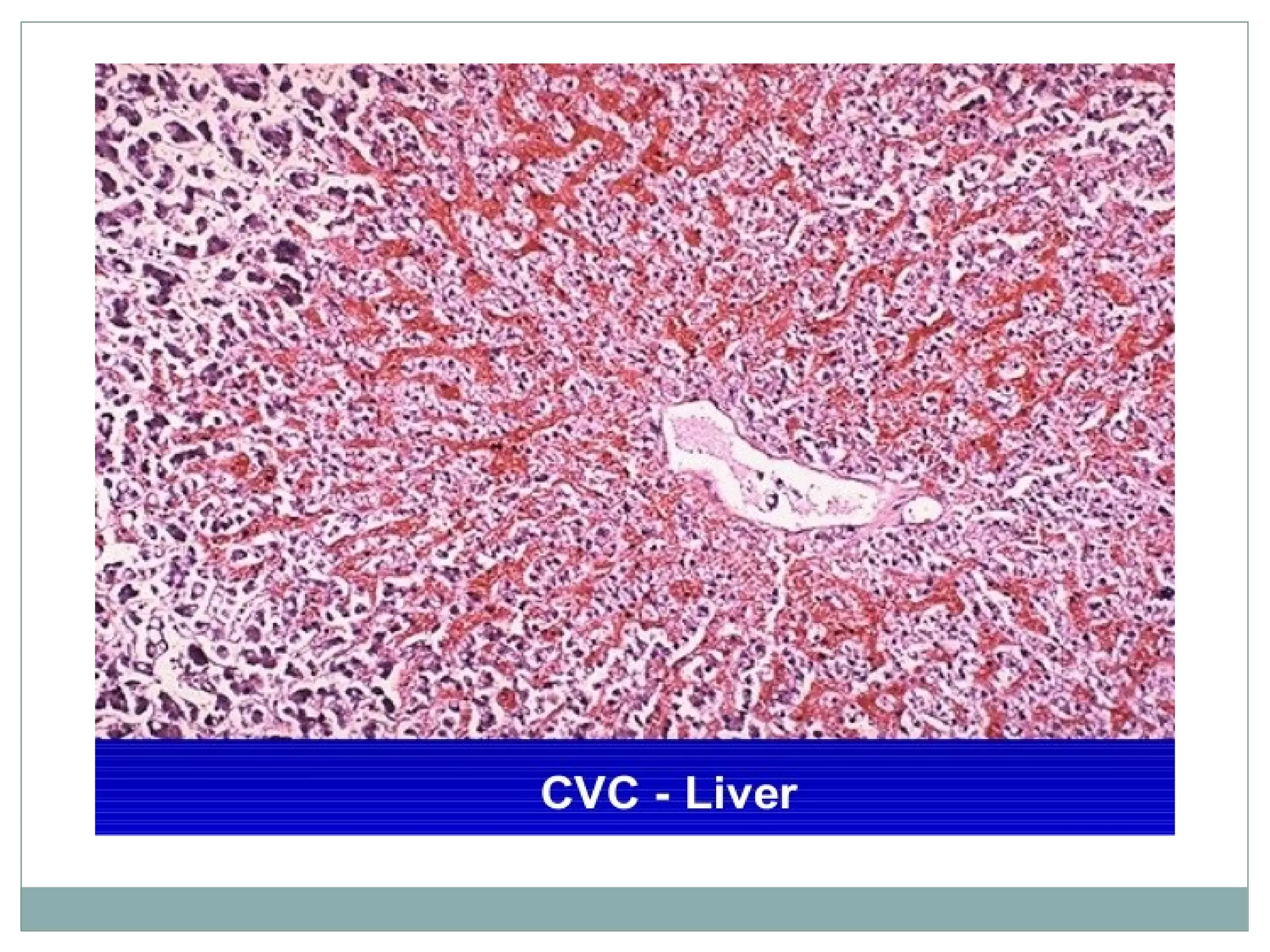 Cvc lung, liver and spleen | PPT