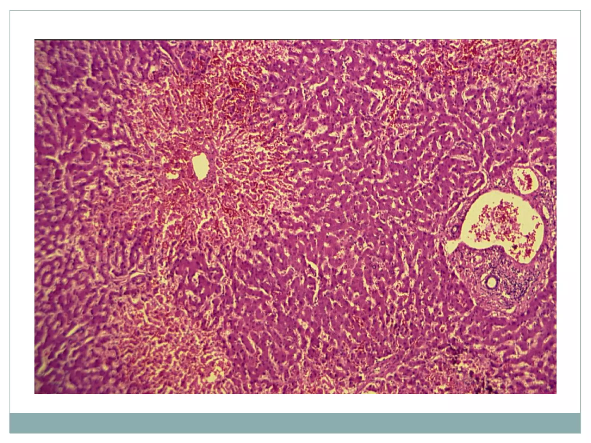 Cvc lung, liver and spleen | PPT