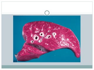 Cvc lung, liver and spleen | PPT