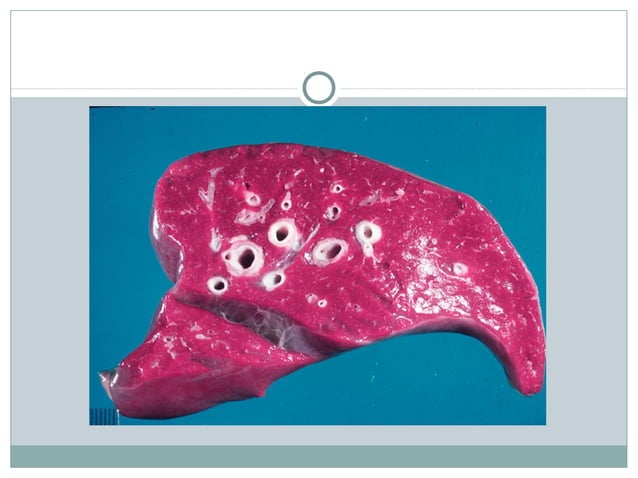 Cvc lung, liver and spleen | PPT | Heart and Cardiovascular Diseases ...