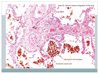 Cvc lung, liver and spleen | PPT