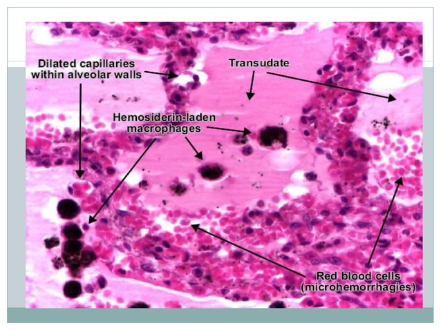 Cvc lung, liver and spleen | PPT | Heart and Cardiovascular Diseases ...
