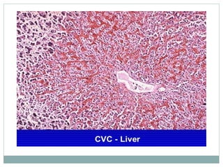 Cvc lung, liver and spleen | PPT