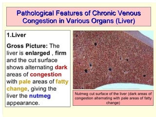 Nutmeg Liver Histology
