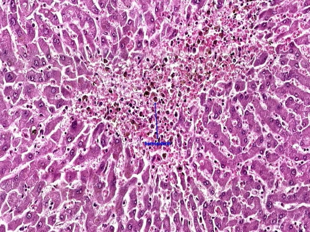 Cvc lung, liver and spleen