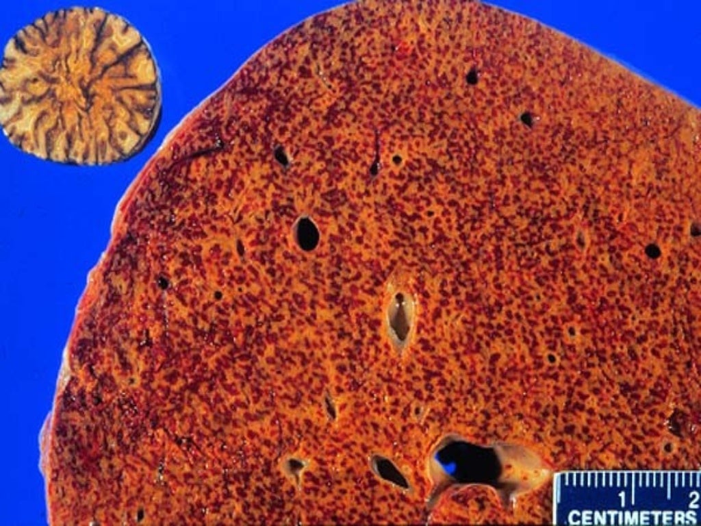 Cvc lung, liver and spleen