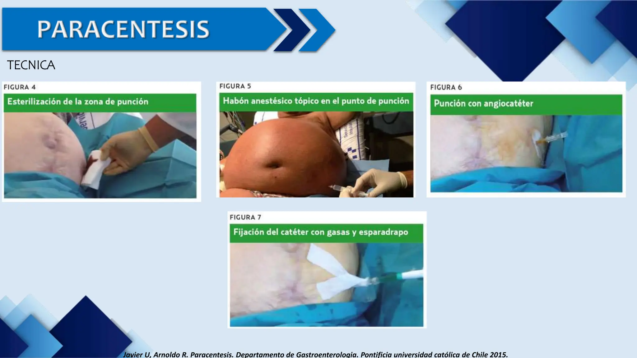 CVC, paracentesis y lavado peritoneal definitivo.pptx