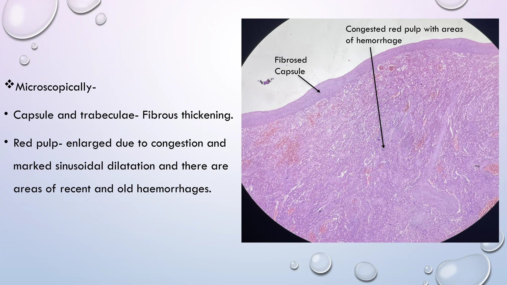 CVC spleen for 2nd year mbbs students pathology | PPTX