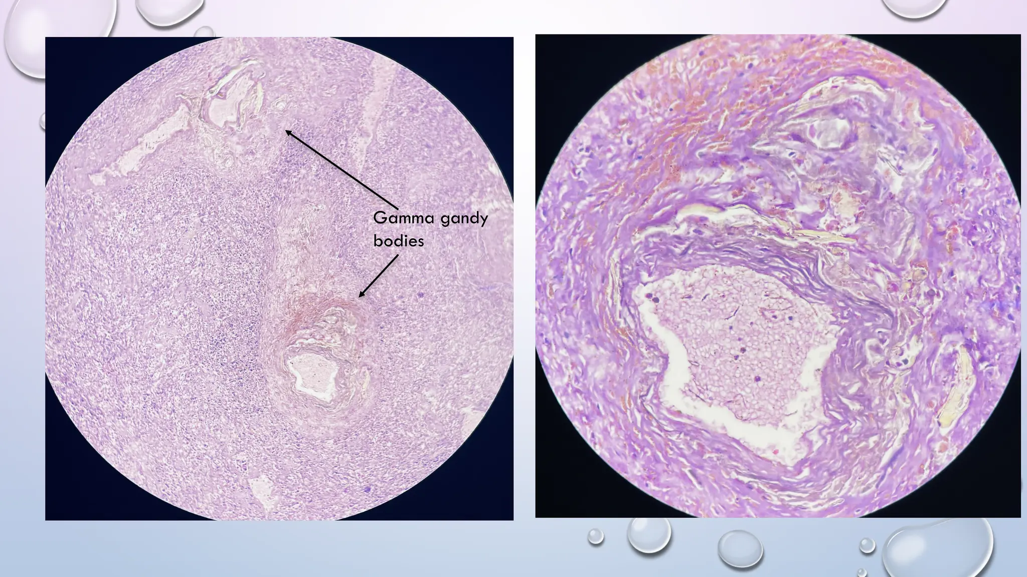 CVC spleen for 2nd year mbbs students pathology | PPTX