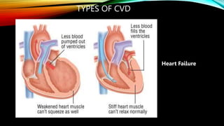 CVD.pptx | Free Download