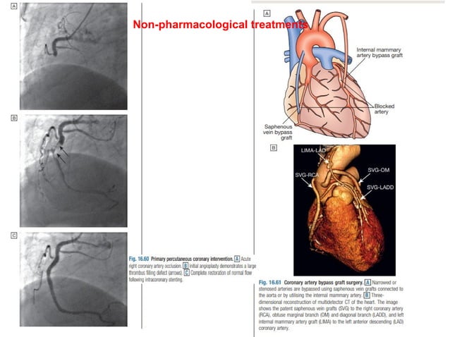 CVD........................... LEC4.pptx