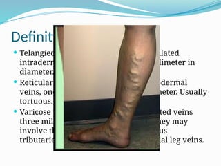 venous insufficiency nuts and bolts defining CVD | PPT