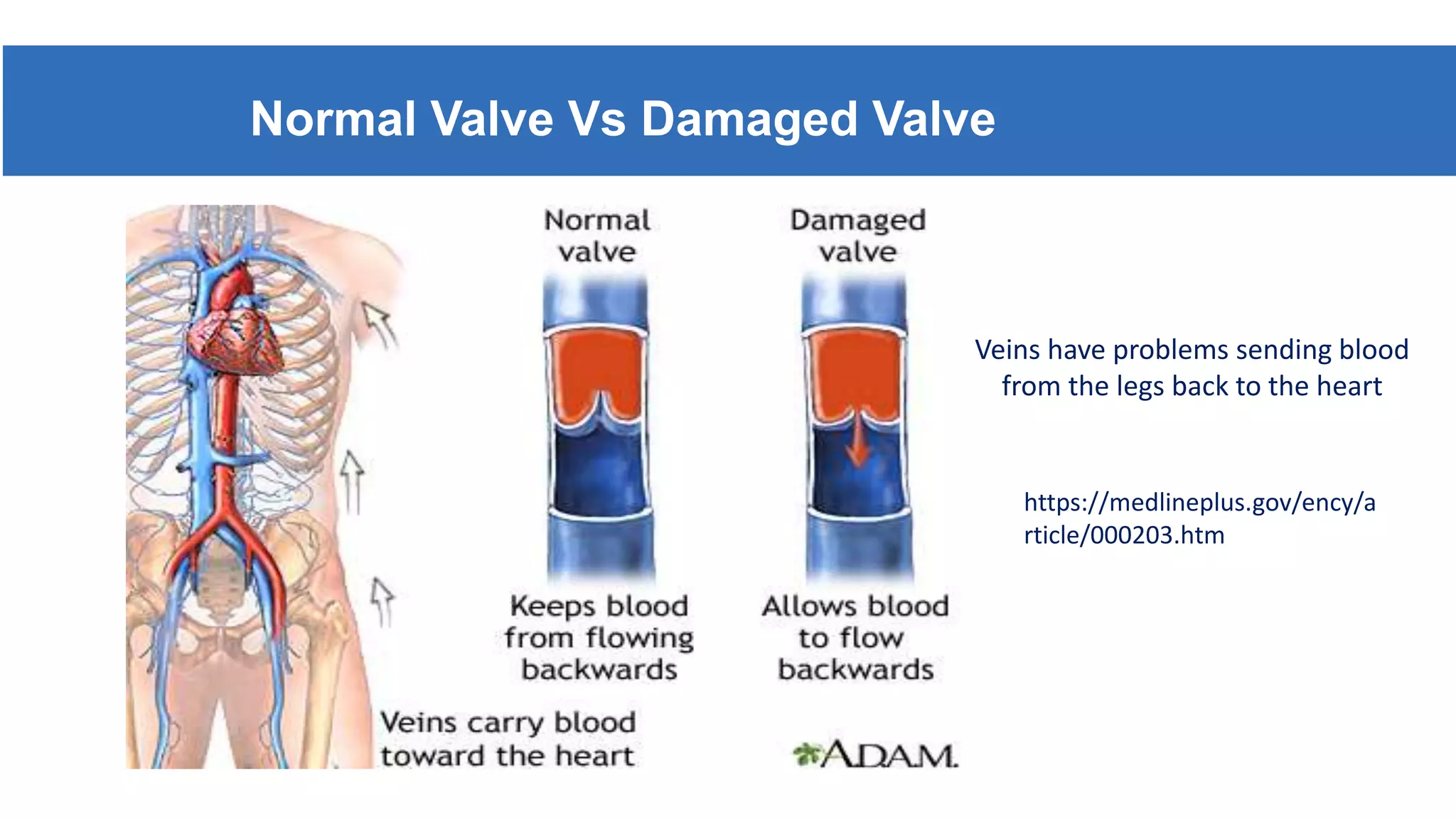 CHRONIC VENOUS DISEASE: From pathogenesis to clinicals | PPTX