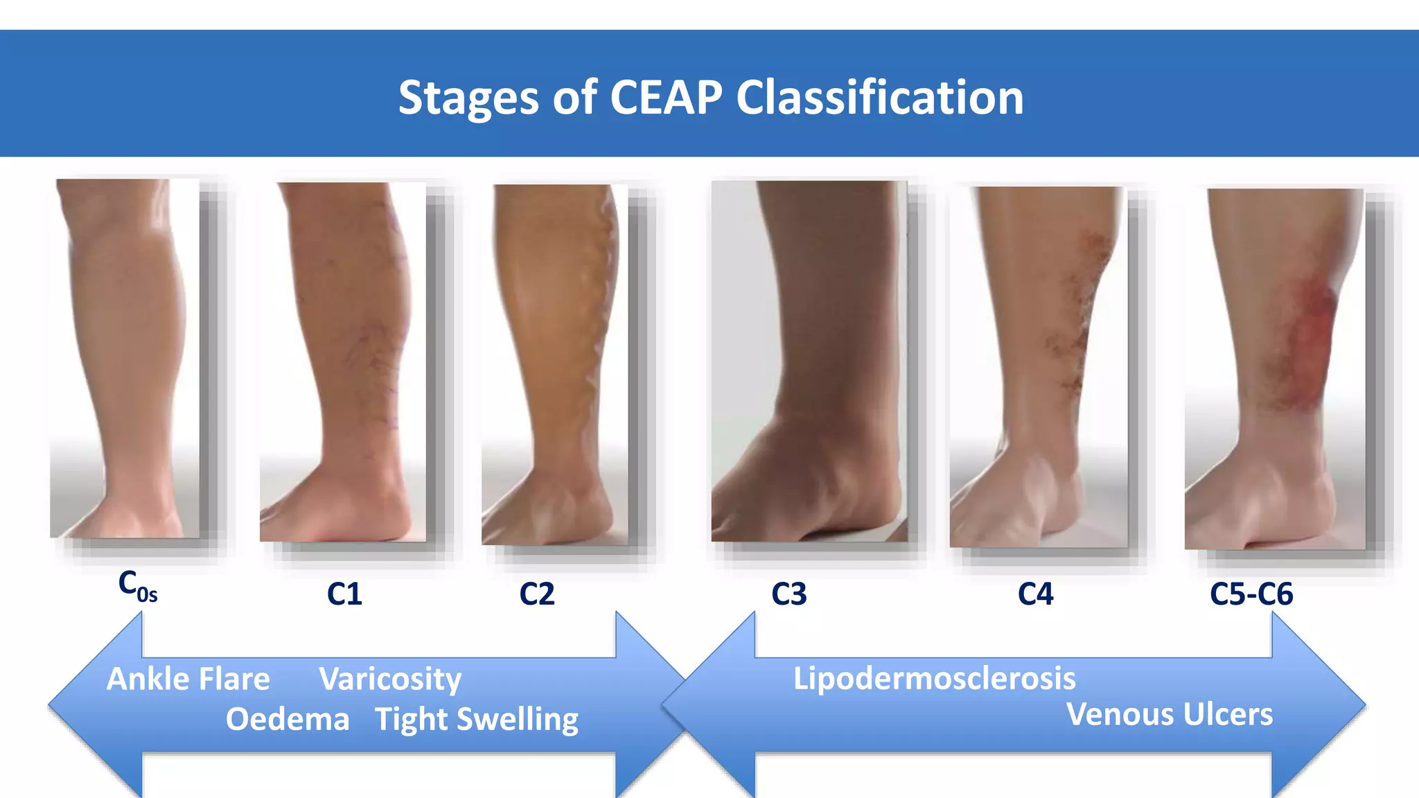 CHRONIC VENOUS DISEASE: From pathogenesis to clinicals | PPTX