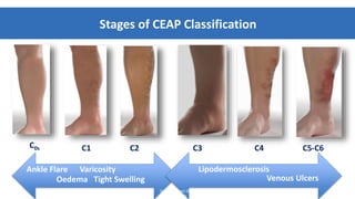 Chronic Venous Disease: From Pathogenesis to Clinical Practice | PPT