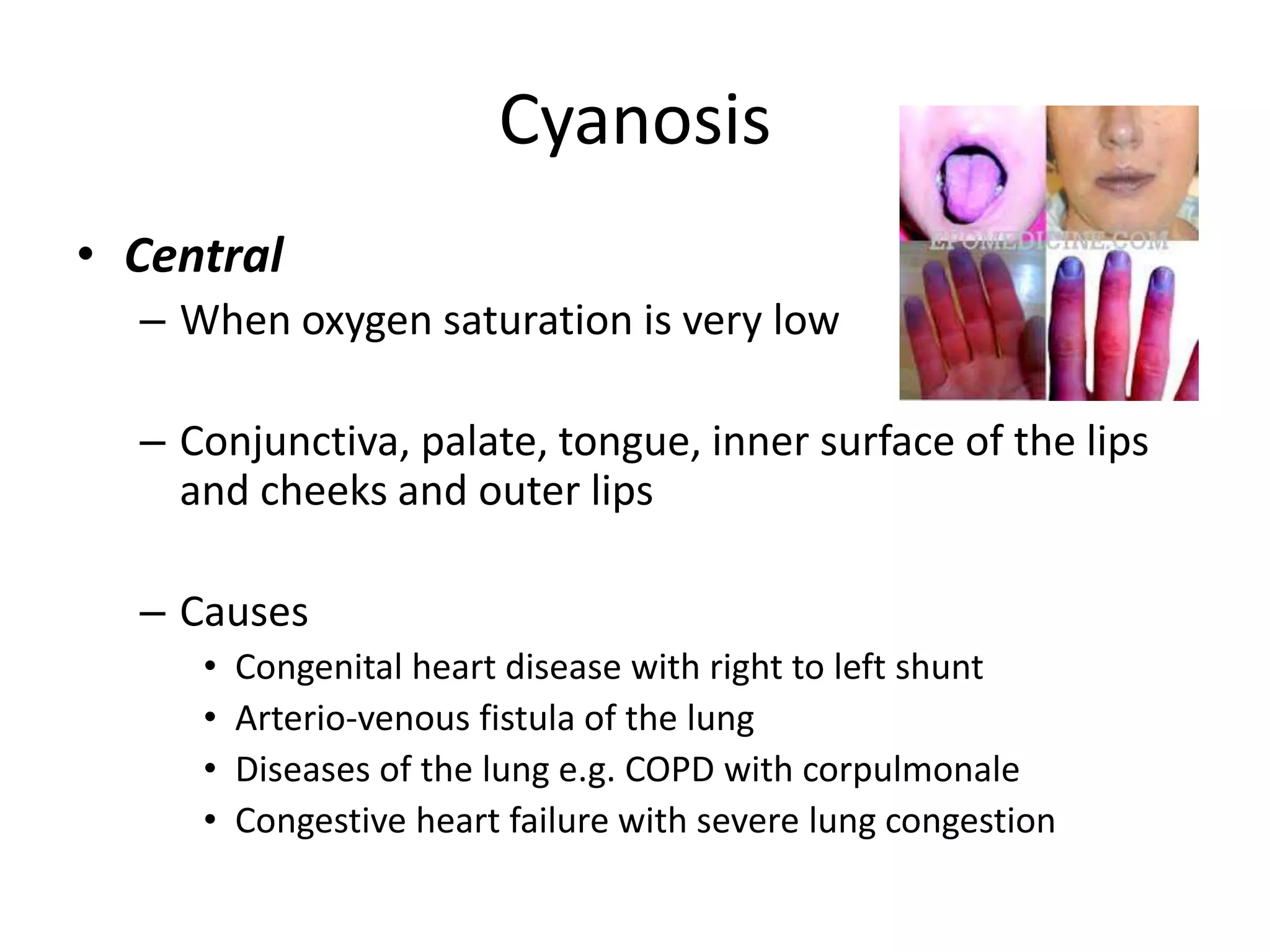 Cvd signs and symptoms | PPTX