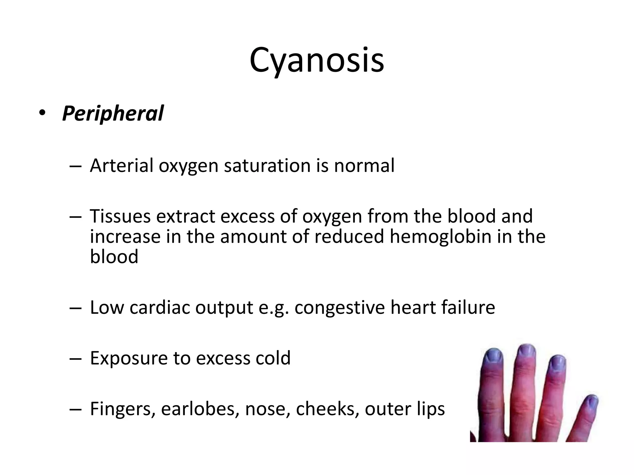 Cvd signs and symptoms | PPTX