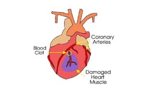 NCDs 1: Cardiovascular diseases basics and Rheumatic Heart Disease | PPTX