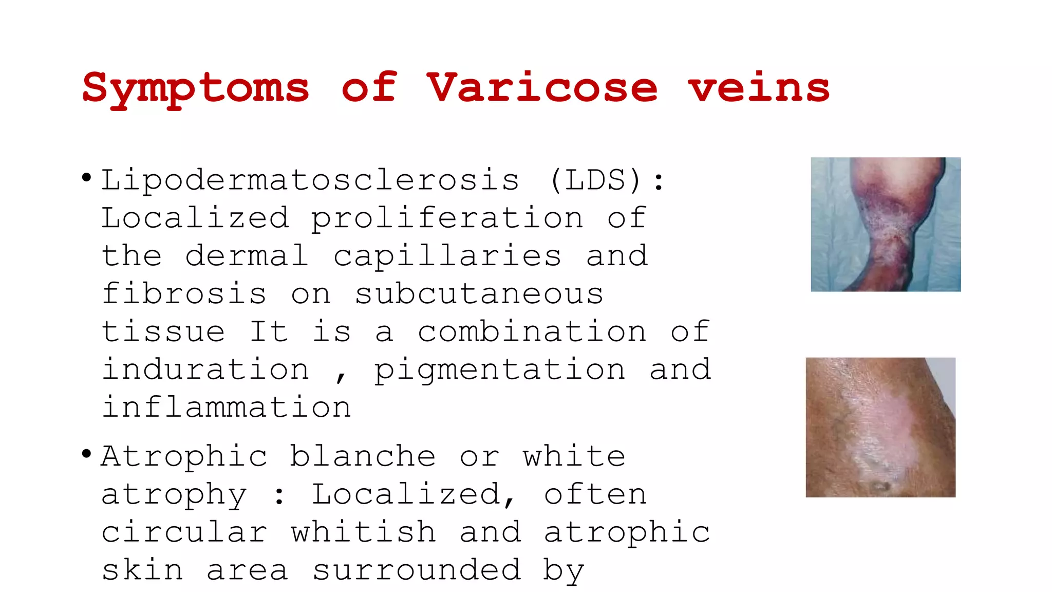 Chronic Venous insufficiency Overview.pptx