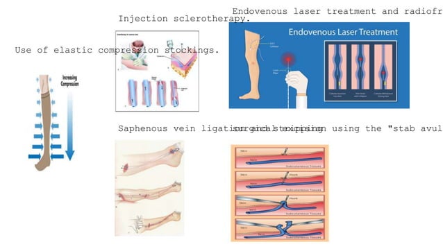 Chronic Venous insufficiency Overview.pptx