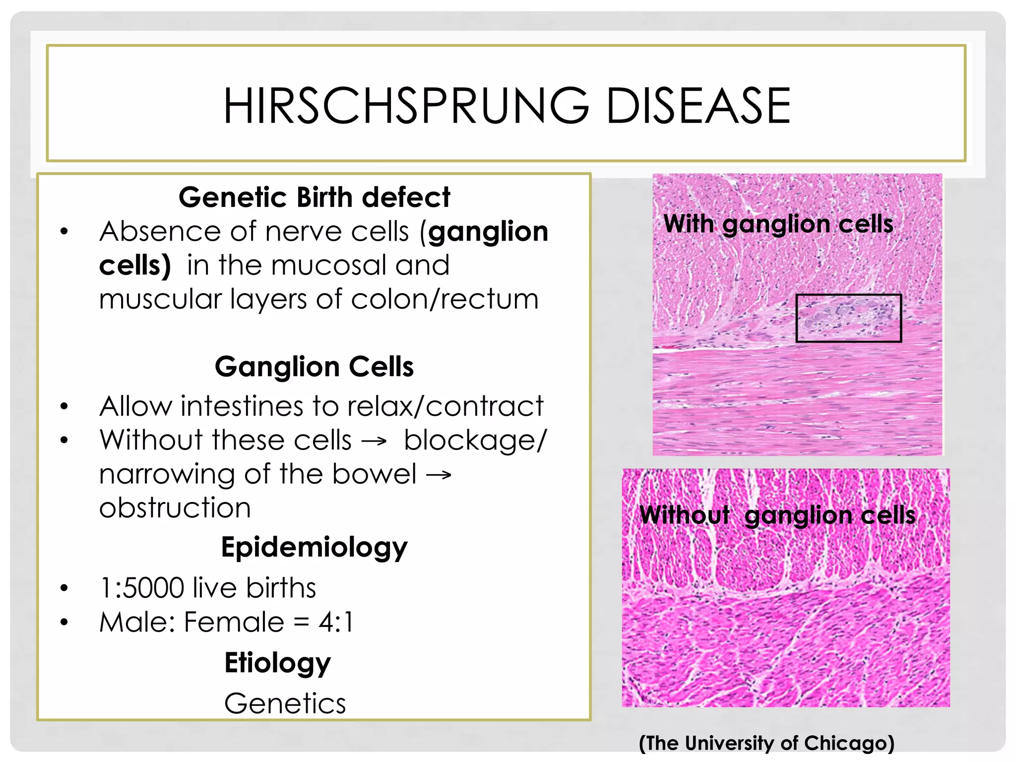 Pediatric Case Study of Hirschsprung Disease | PDF