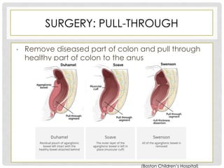 Pediatric Case Study of Hirschsprung Disease | PDF