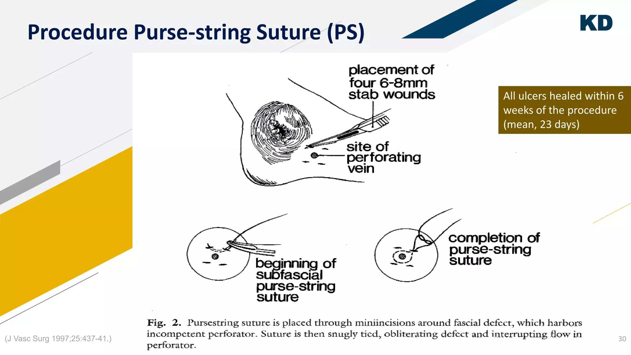 chronic venous insufficiency | PPTX