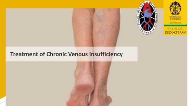 chronic venous insufficiency | PPTX