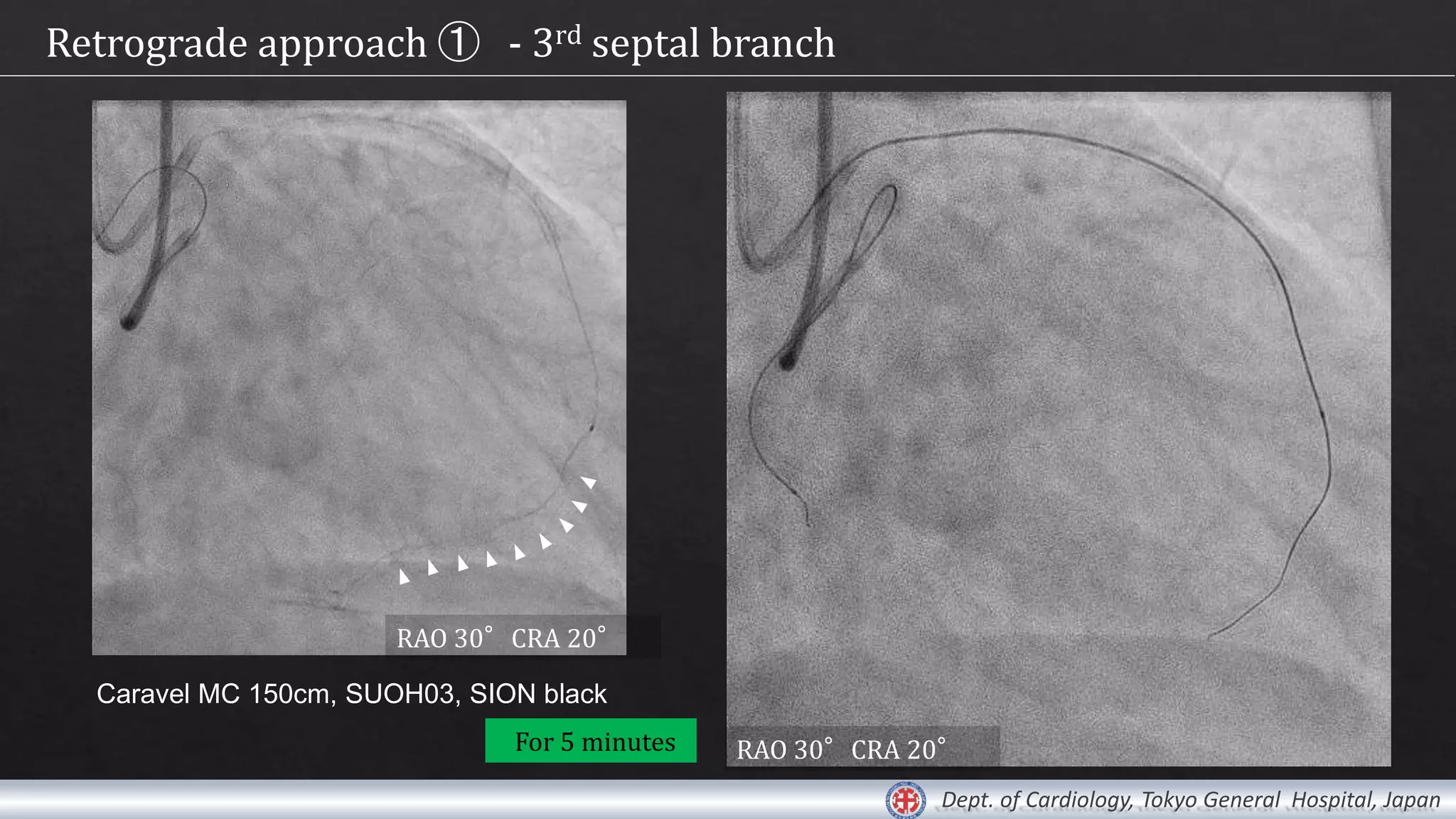 Successful PCI for RCA CTO with Knuckle wire technique and reverse CART ...
