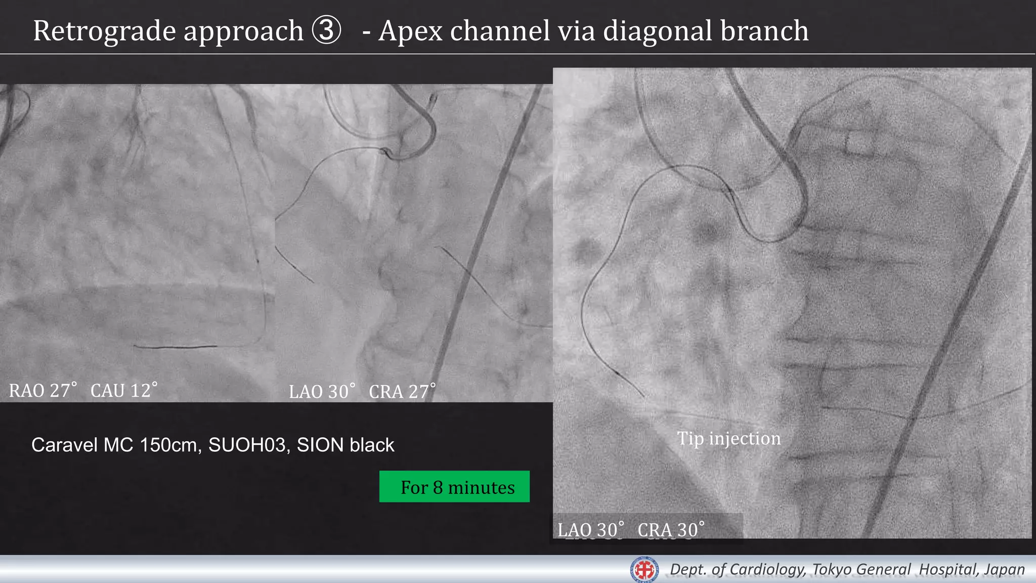 Successful PCI for RCA CTO with Knuckle wire technique and reverse CART | PPT