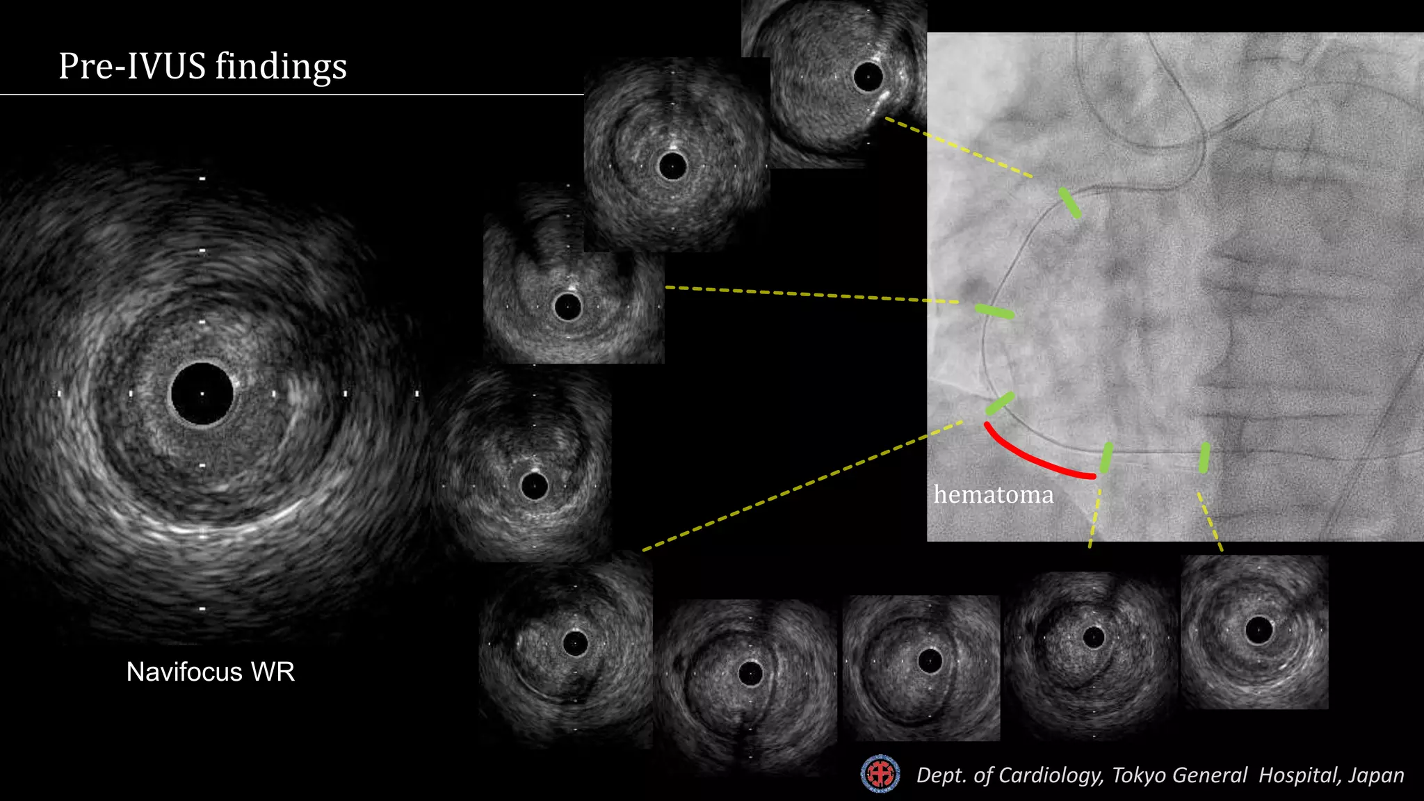 Successful PCI for RCA CTO with Knuckle wire technique and reverse CART ...