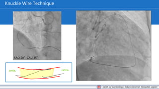 Successful PCI for RCA CTO with Knuckle wire technique and reverse CART ...