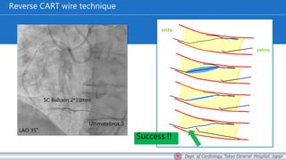 Successful PCI for RCA CTO with Knuckle wire technique and reverse CART ...