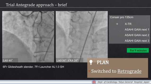 Successful PCI for RCA CTO with Knuckle wire technique and reverse CART ...