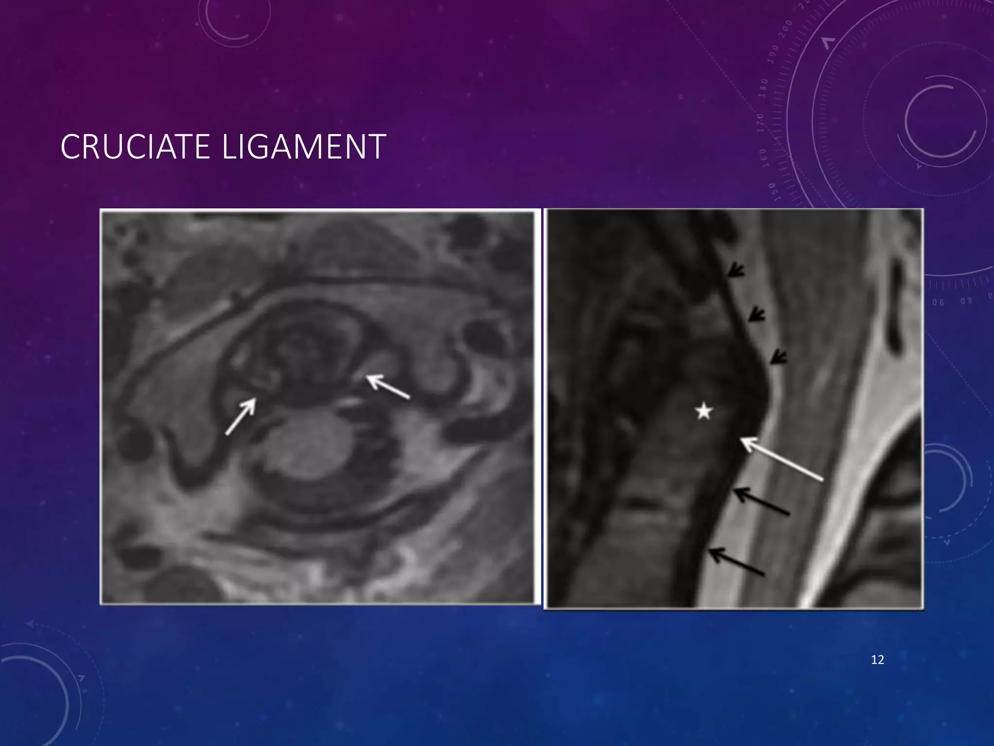 Imaging in CranioVertebral Junction Anomalies | PPTX
