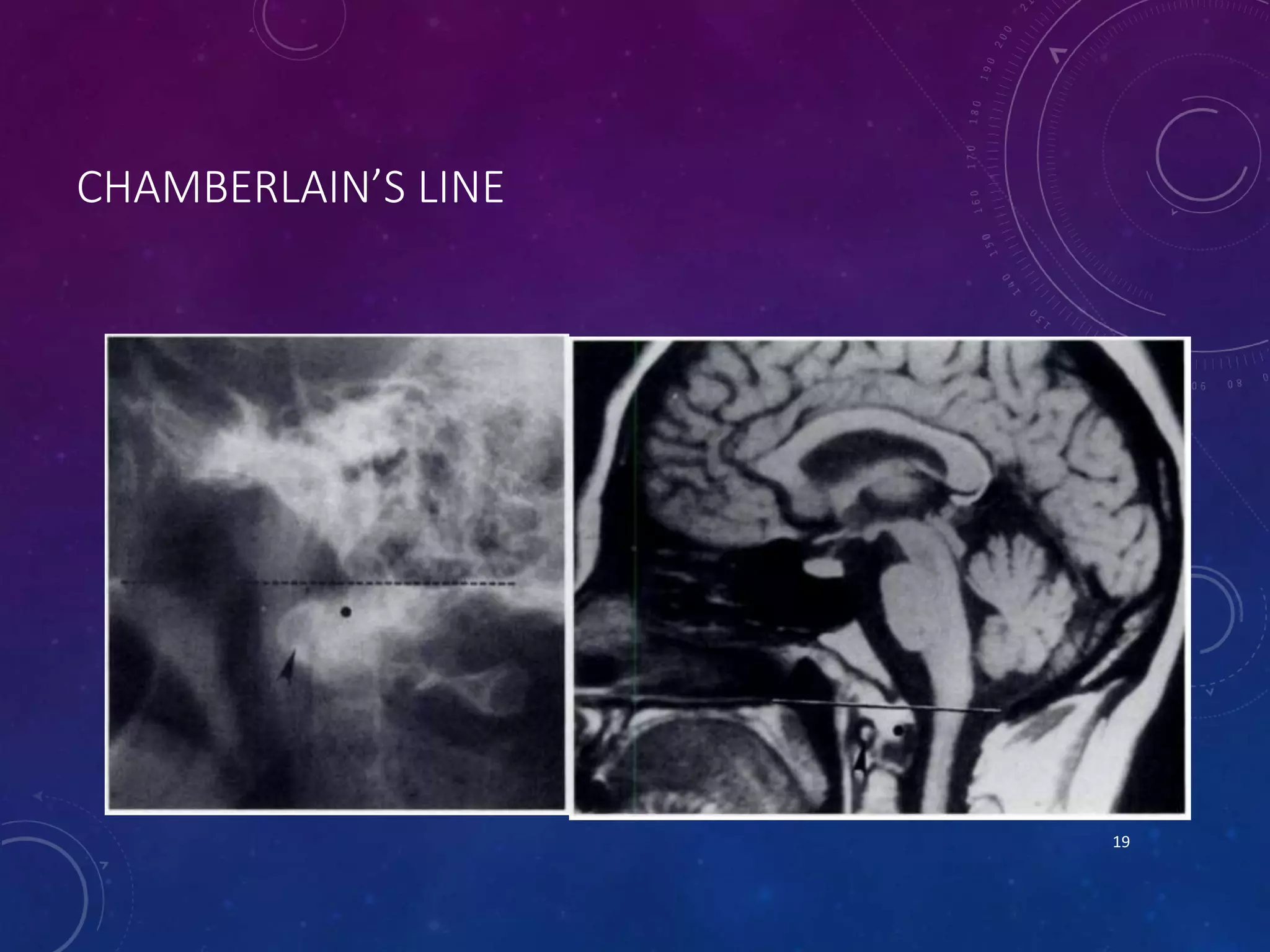 Imaging in CranioVertebral Junction Anomalies | PPTX