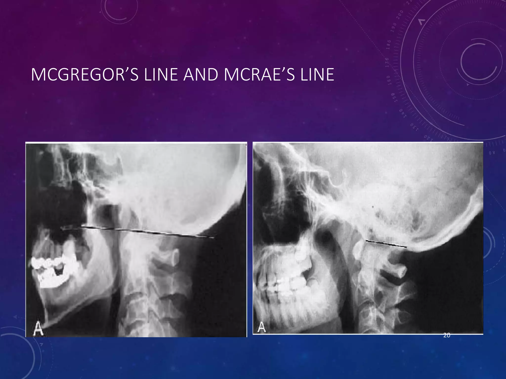Imaging in CranioVertebral Junction Anomalies | PPTX