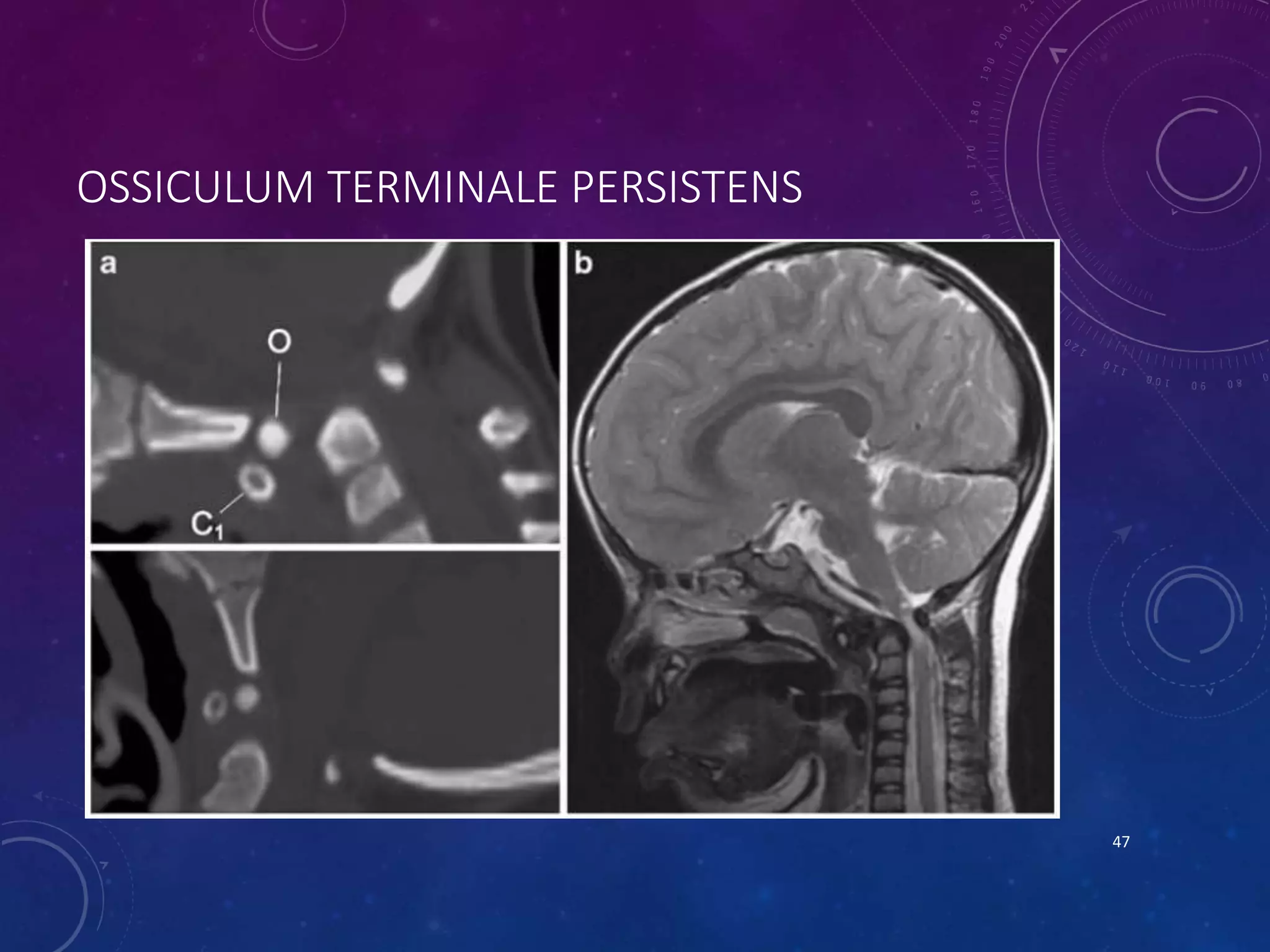 Imaging in CranioVertebral Junction Anomalies | PPTX