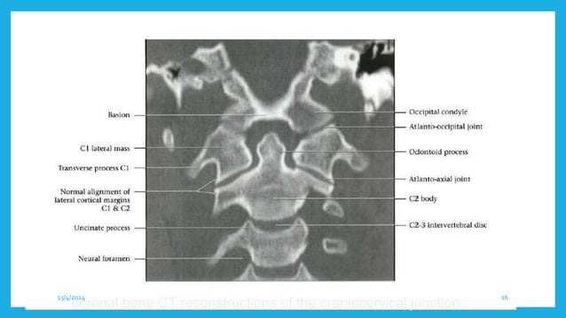 CRANIO VERTEBRAL JUNCTION RADIOLOGICAL ANATOMY .pptx