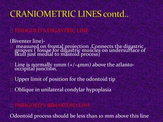 Cranio-vertrable junction anamolies | PPTX