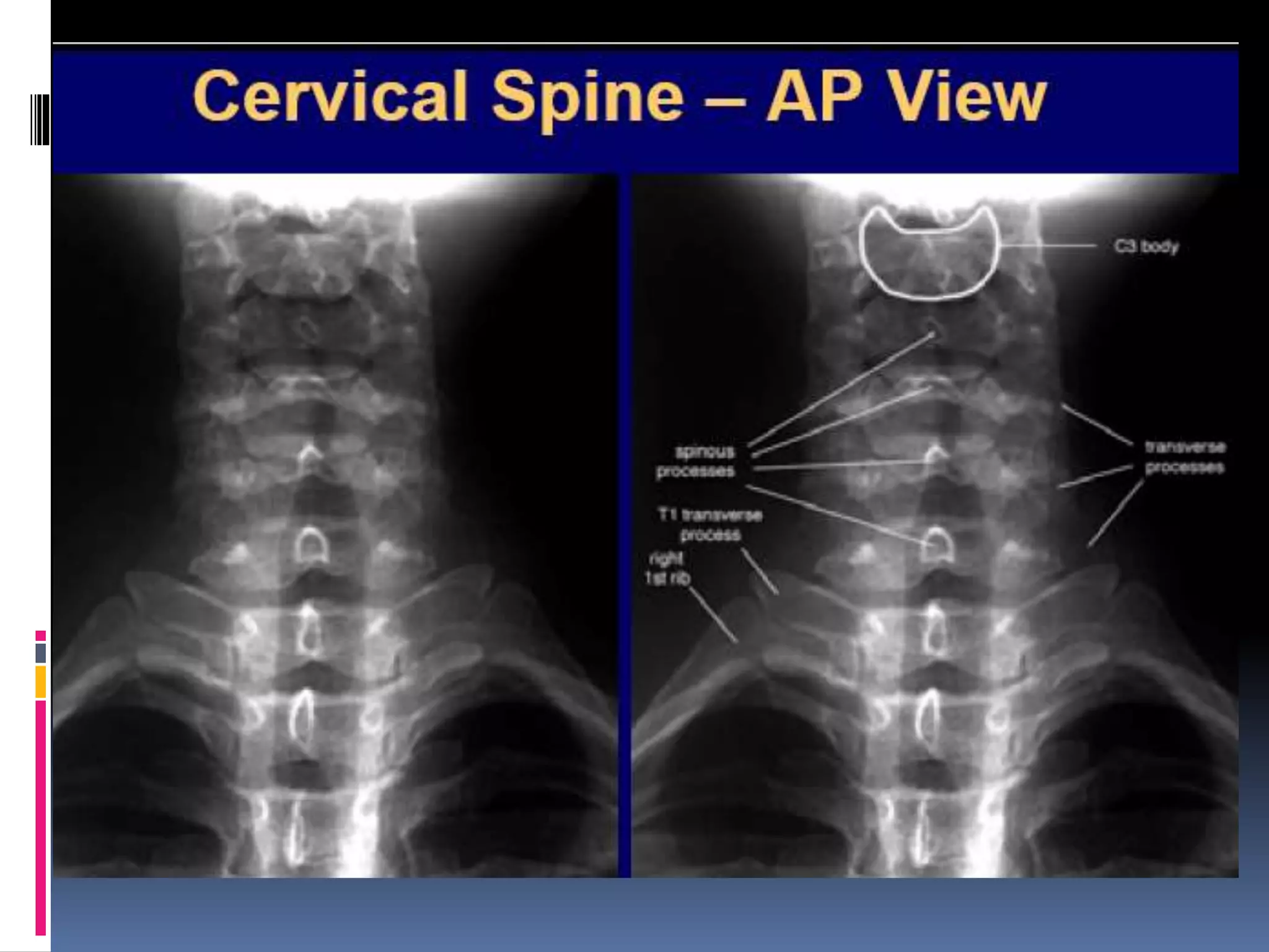 imaging of the craniovertebral junction | PPTX