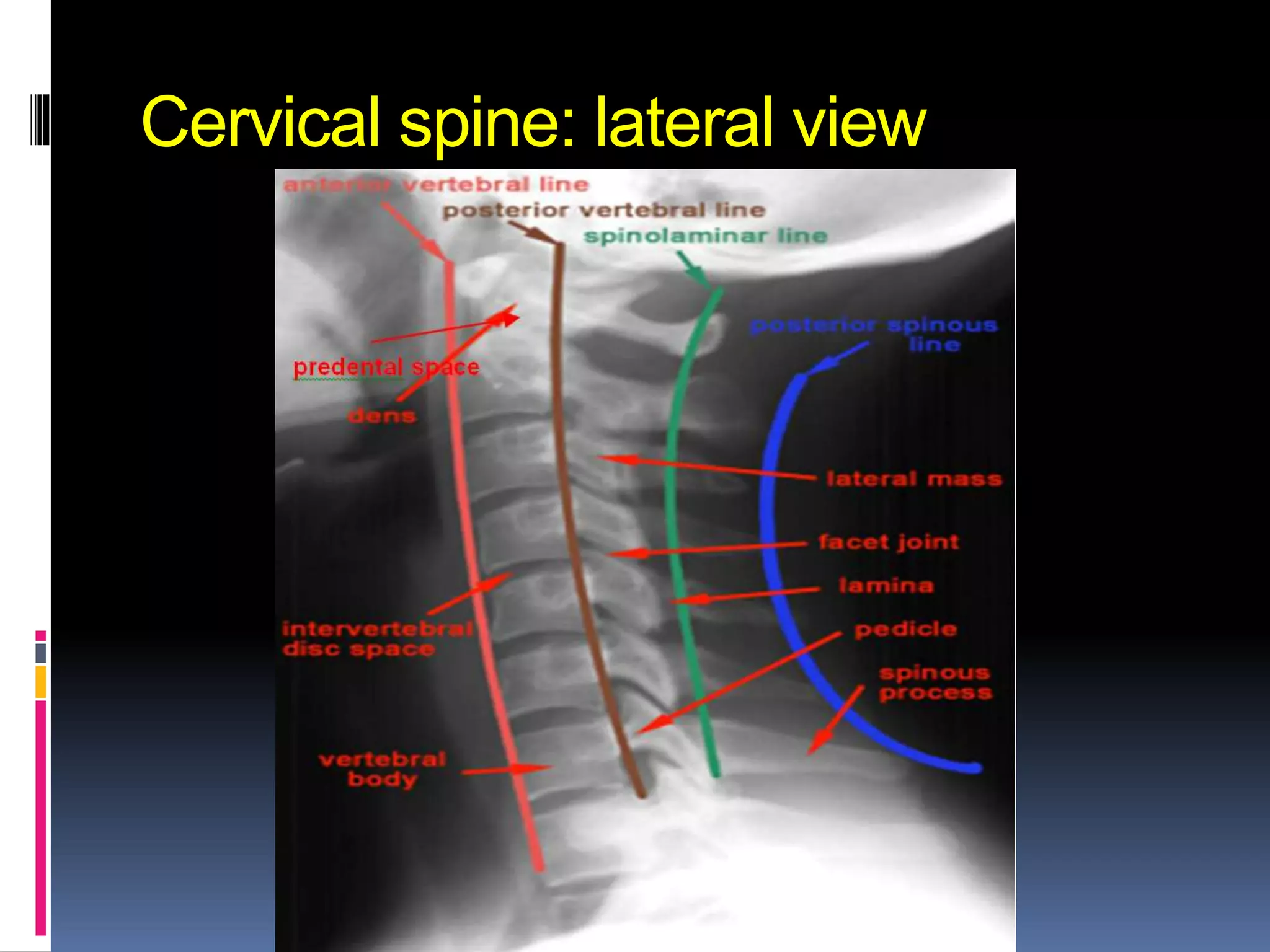 imaging of the craniovertebral junction | PPTX