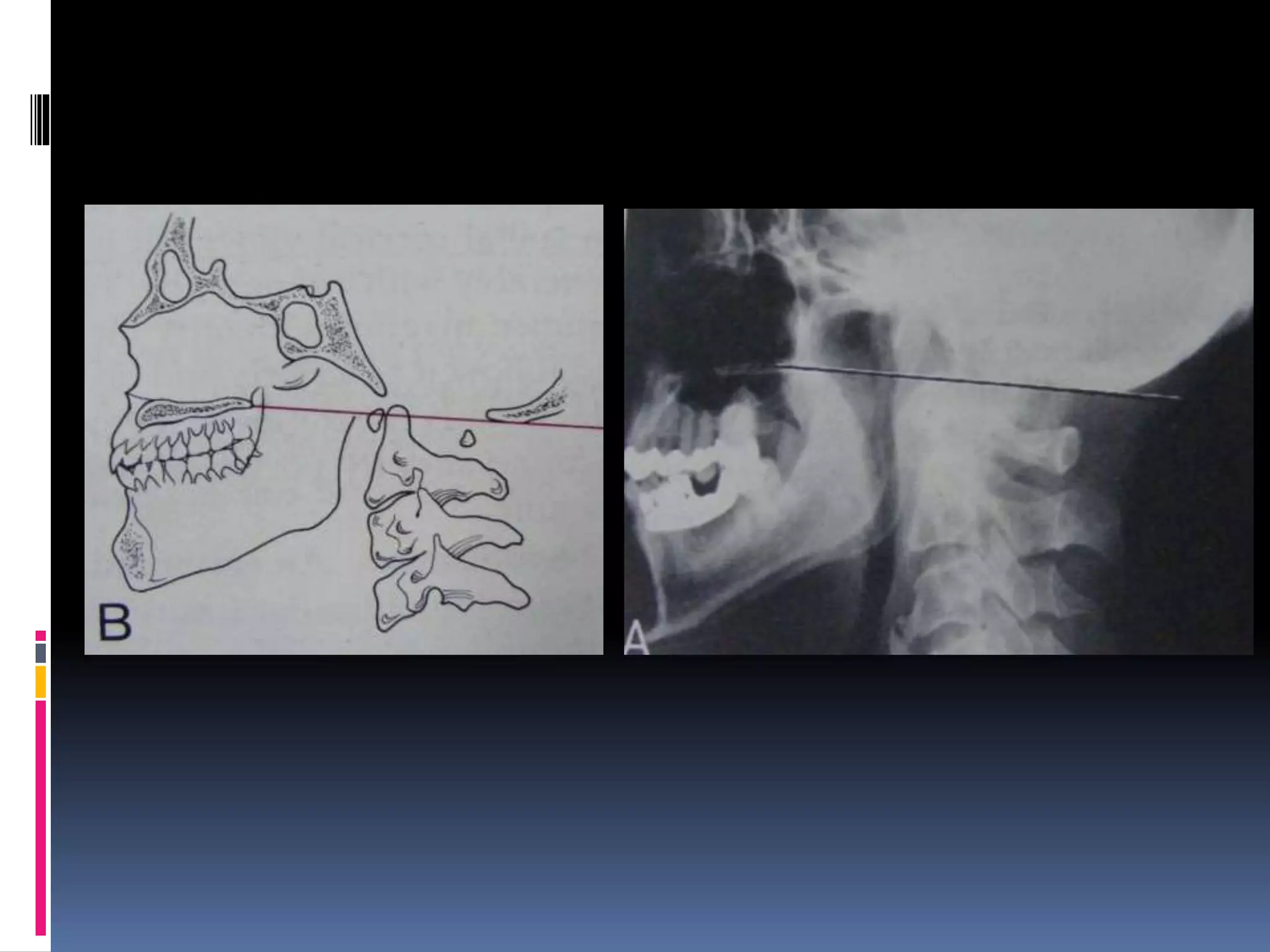imaging of the craniovertebral junction | PPTX