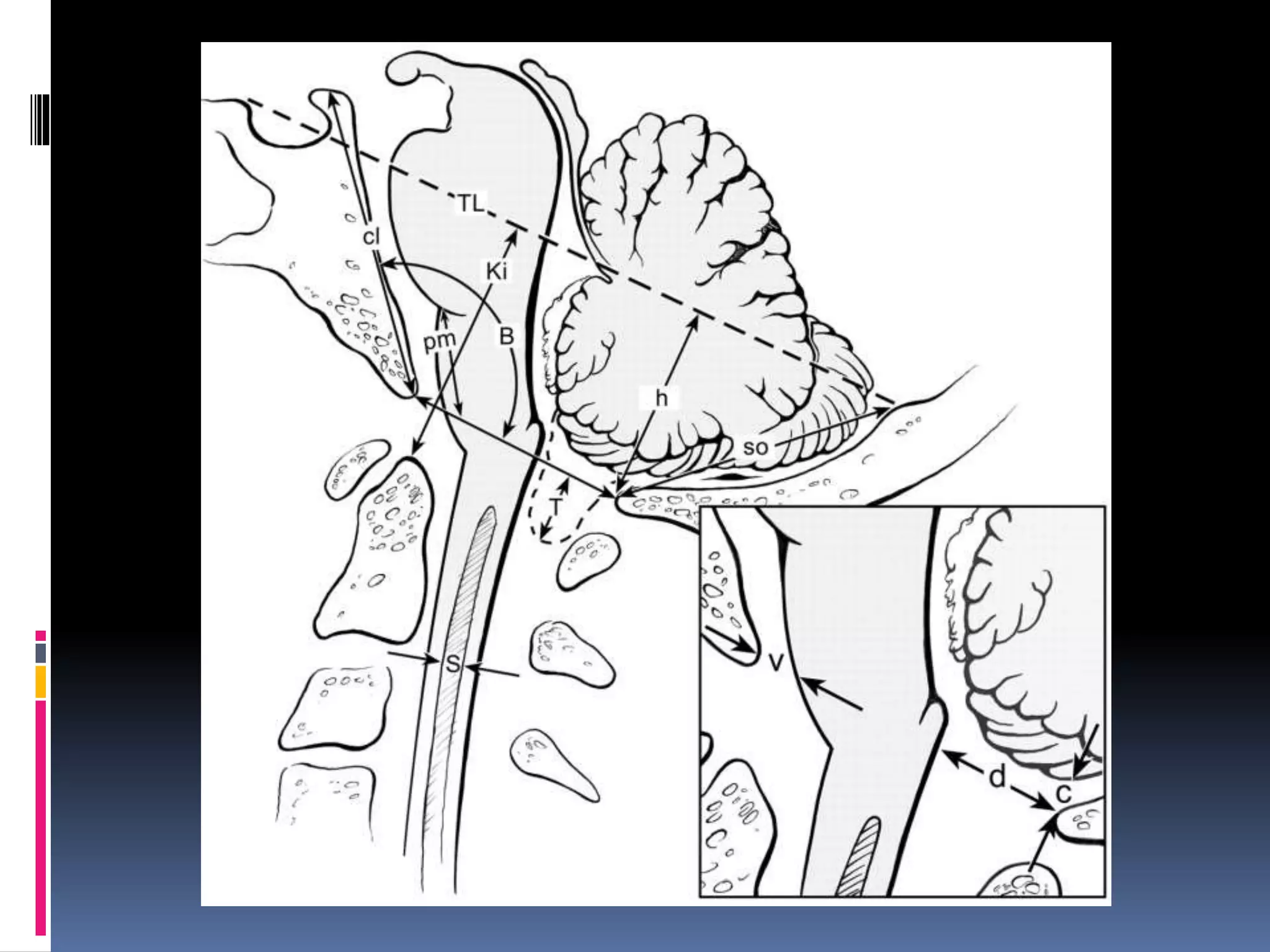 imaging of the craniovertebral junction | PPTX