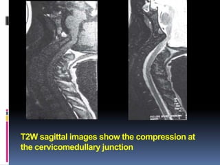 imaging of the craniovertebral junction | PPTX
